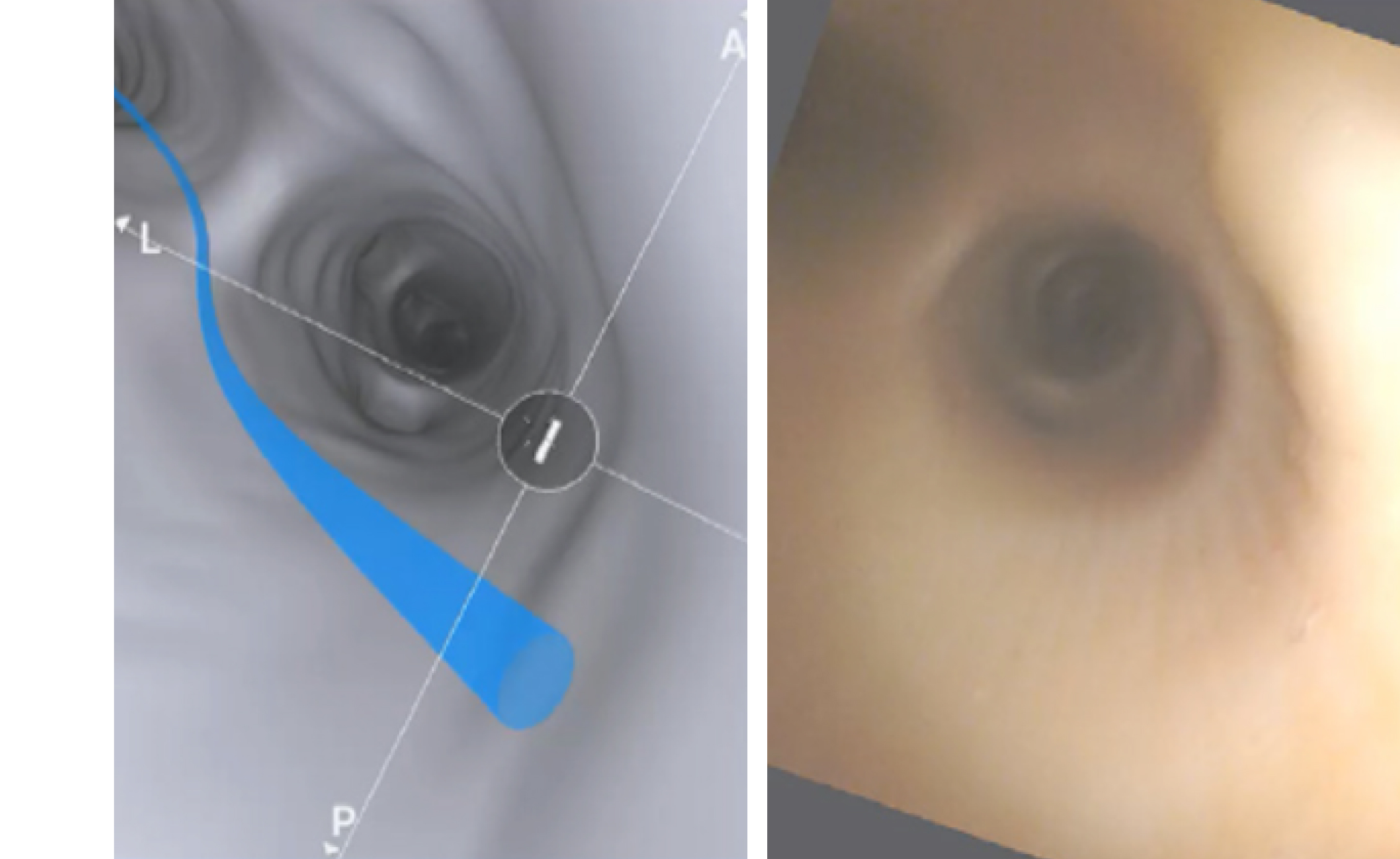 Intuitive | Robotic Assisted Bronchoscopy | How Ion Works